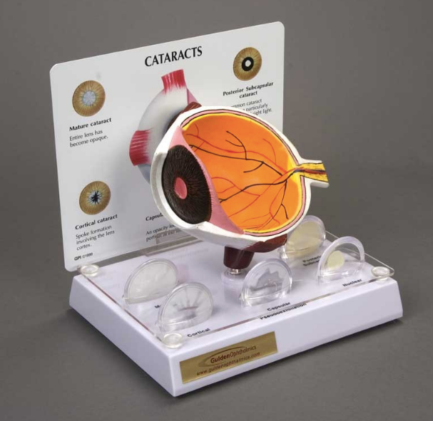 Eye Model - Cataract – Optego Singapore